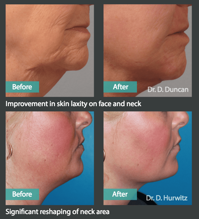 FaceTite Austin TX | NeckTite | Dr. Jennifer Walden