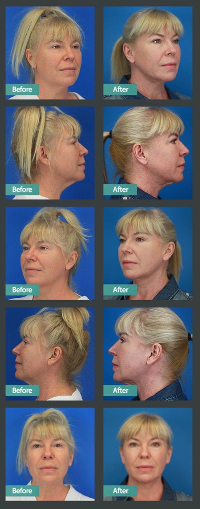 FaceTite Austin TX - NeckTite Neck Lift Bee Cave TX